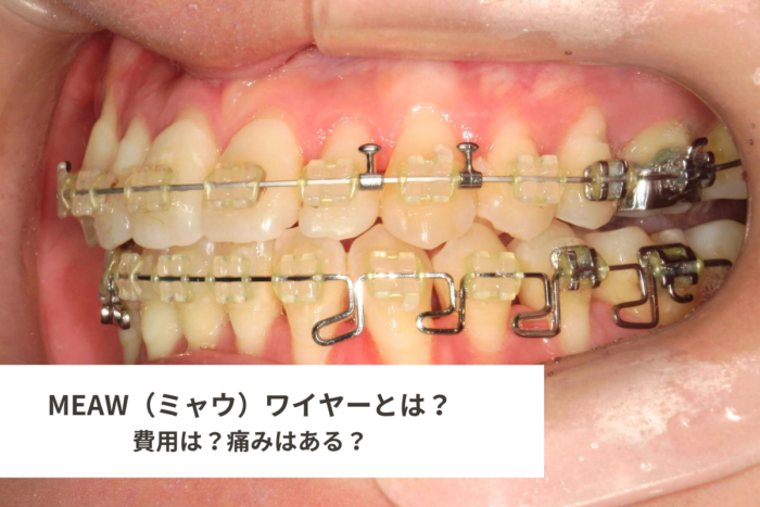 MEAW（ミャウ）ワイヤーとは？費用は？痛みはある？【大宮駅2分】大宮SHIN矯正歯科